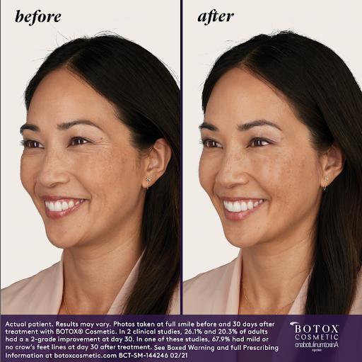 "Baby" Botox® – Alexandria Associates in Dermatology